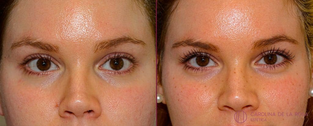 Micropigmentación o tatuaje de Pecas y Lunares Barcelona
